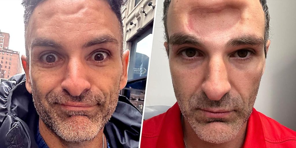 They Removed His Forehead to Save His Life